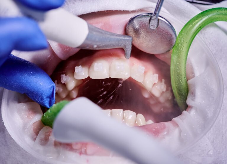 Fillings - ashteaddental.co.uk