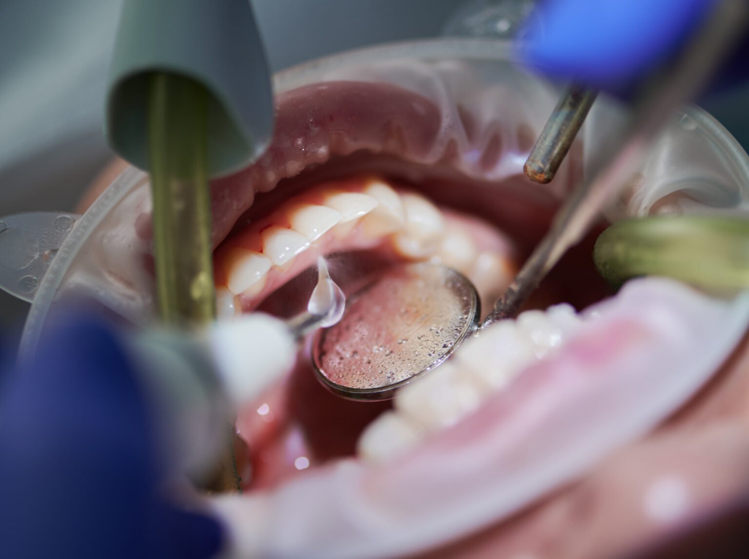 Root-End Endodontic Surgery (Apicoectomy) - ashteaddental.co.uk